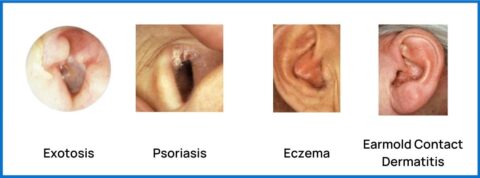 Common Conditions of the External Ear – Pacific Audiology Group